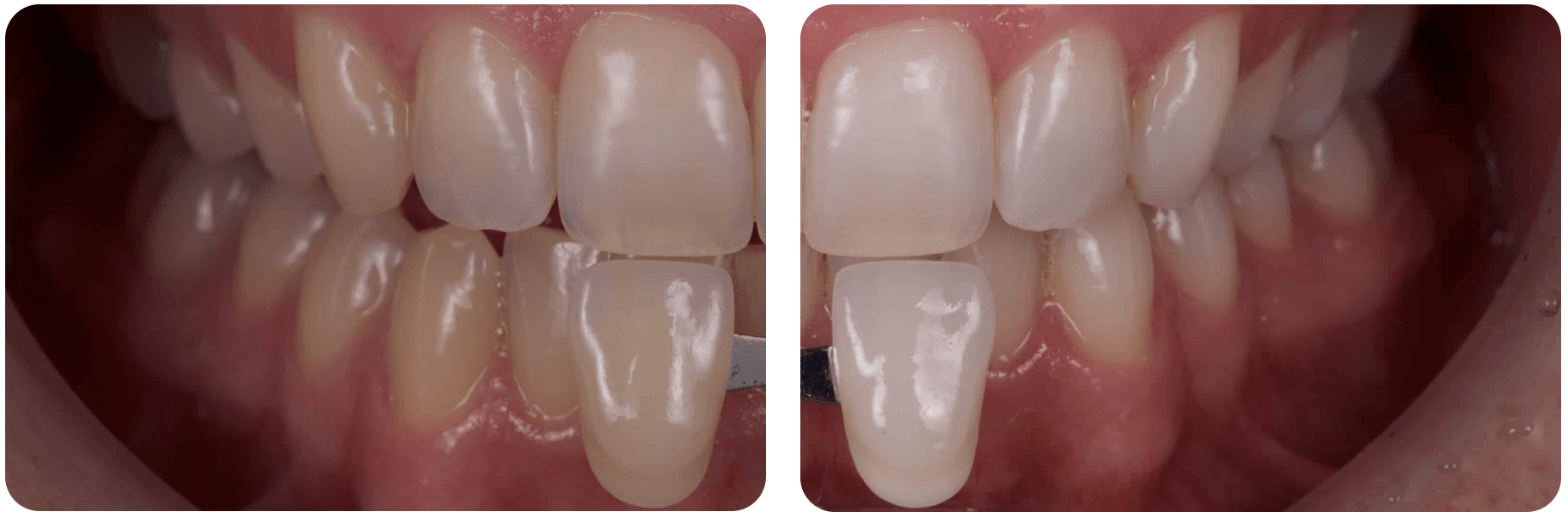Vijf redenen om thuisbleken aan te raden voor uw patiënten | KDental